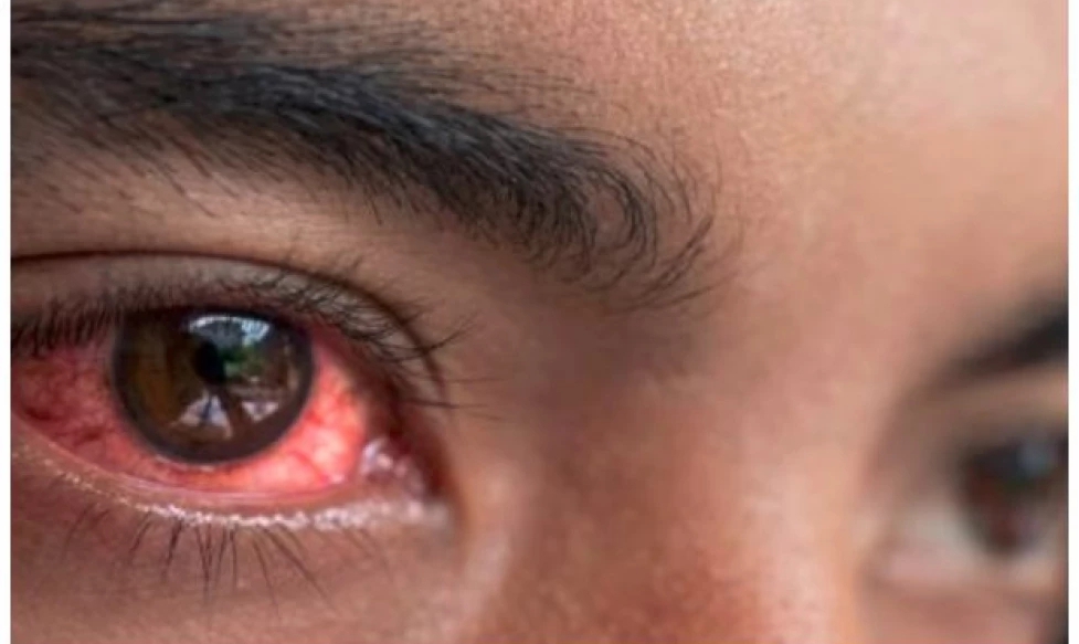 Alert! Red Eyes Disease Breaks out in Kampala Schools - UG Standard ...